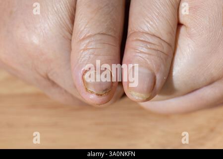 Cancer chemotherapy cause swelling hand , skin to become dry, dark or ...