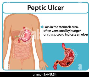 Illustration of peptic ulcer symptoms and affected areas Stock Vector ...