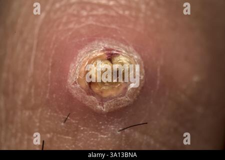 The sore on the toe joint has completely hardened Stock Photo - Alamy