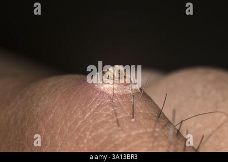 The sore on the toe joint has completely hardened Stock Photo - Alamy
