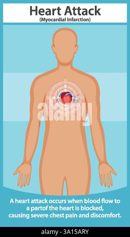 Illustration of heart attack and its effects Stock Vector Image & Art ...