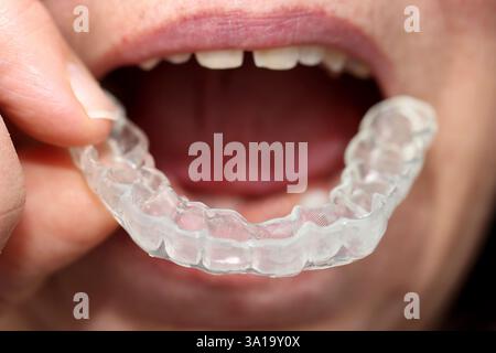 A grinding splint prevents the teeth from wearing down Stock Photo - Alamy