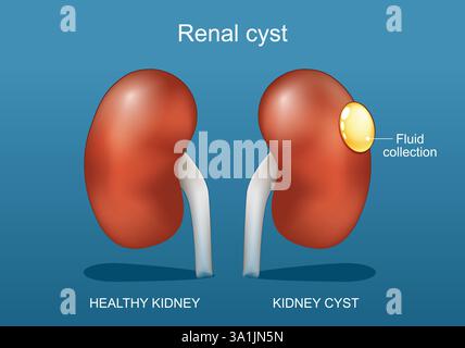 Polycystic kidney disease. Normal human kidney and polycystic kidney ...