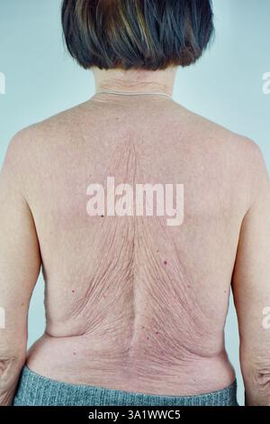 Arthritic Womens Back with Spinal Deformities and Osteoporosis. High ...