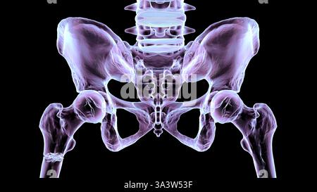 Illustration of a subtrochanteric femur fracture, depicting a break ...
