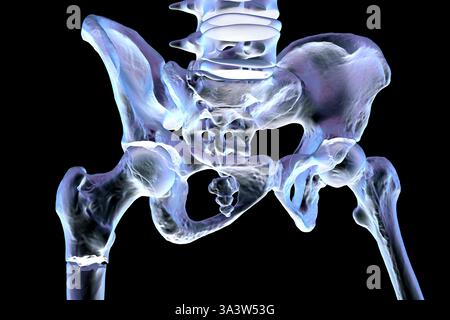 Illustration of a subtrochanteric femur fracture, depicting a break ...