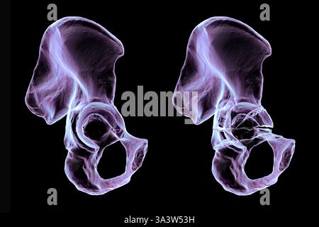 Illustration of pelvic bones with an acetabulum fracture, a break in ...