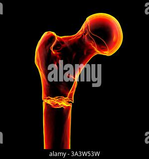 Illustration of a subtrochanteric femur fracture, depicting a break ...