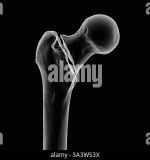Illustration of a basicervical femur fracture, showing a break at the ...