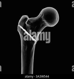 Illustration of an intertrochanteric femur fracture, showing a break ...