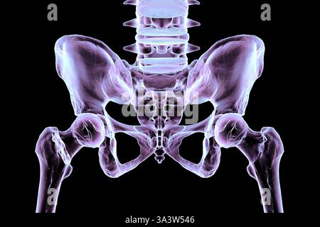Illustration of a basicervical femur fracture, showing a break at the ...