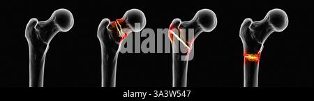 Illustration of femur neck fracture types: subcapital, transcervical ...