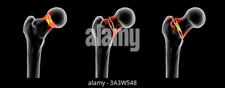 Illustration of femur neck fracture types: subcapital, transcervical ...