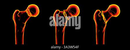 Illustration of femur neck fracture types: subcapital, transcervical ...