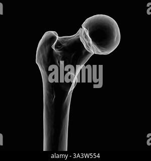 Illustration of a subcapital femur fracture, showing a break just below ...