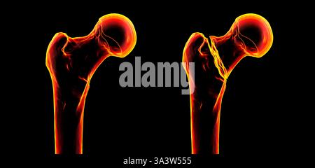 Illustration of a basicervical femur fracture (right) showing a break ...
