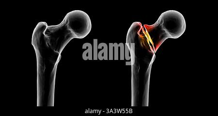 Illustration of a femur neck fracture, showing the bone breakage and ...