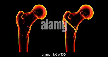 Illustration of an intertrochanteric femur fracture (right) showing a ...