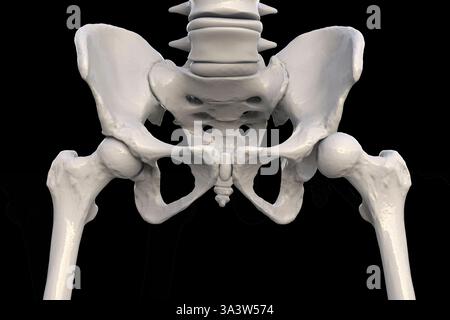 Illustration of hip dysplasia (subluxation type), showing partial ...