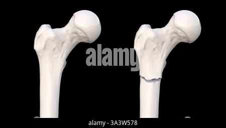 Illustration of a subtrochanteric femur fracture (right) depicting a ...