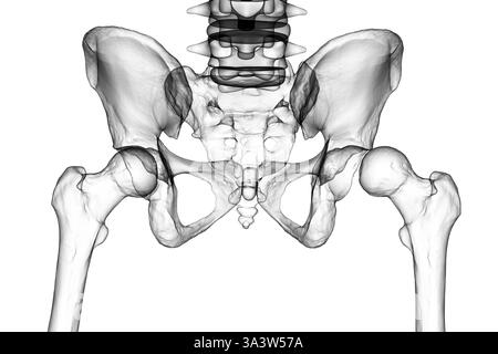 Illustration of hip dysplasia (dislocation type), showing misalignment ...