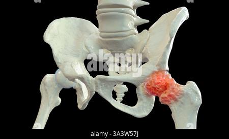 Illustration of hip osteoarthritis, showing joint degeneration ...