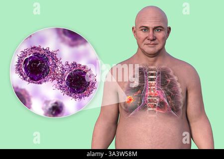 Illustration of man with lung cancer, showing the location and gross ...