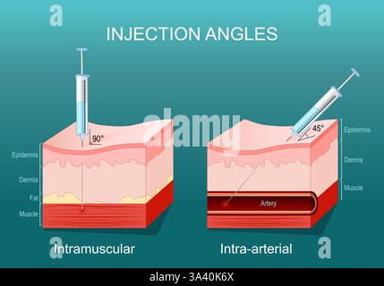 Injection technique. Needle angle. Cross section of human Skin layers ...