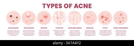 Body skin acne type blackheads, whiteheads, papule, pustule, cyst and ...