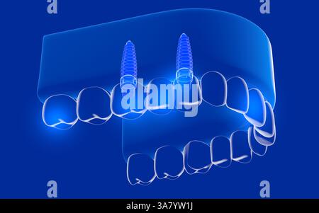 3D illustration of a double implant placed in a transparent glass gum ...