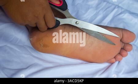 Close up of dry feet. Peeling and cracked foot. Fungal infection or ...