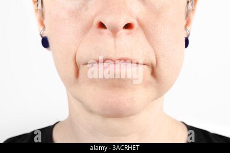 Dental abscess. Close-up of the mouth of a patient with severe tooth ...