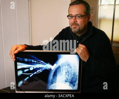Cardiomyopathy, chest X-ray Stock Photo - Alamy