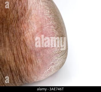 Close up of dry feet. Peeling and cracked foot. Fungal infection or ...