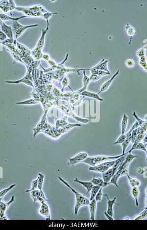 Microscope view of Prostate Cancer cells in tissue culture showing ...