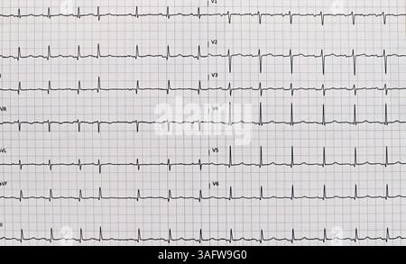 Detailed EKG, electrocardiogram showing heartbeat patterns Stock Photo ...