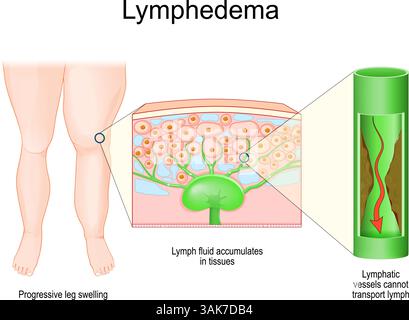 Lymphedema. Cross section of a human skin with healthy lymphatic system, and Lymphatic ...
