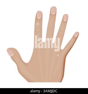 Medical illustration showing common warts growing on a finger and cross ...
