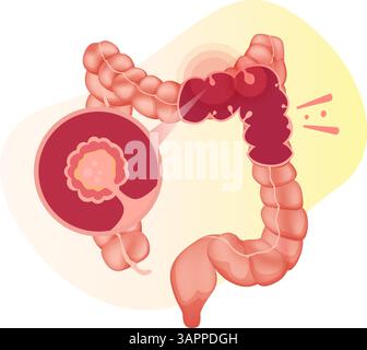 Colorectal polyps and Colon cancer. Human large intestine with ...