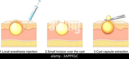 Sebaceous gland or oil gland. Cross-section of all skin layers. A hair ...