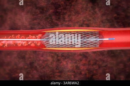 3d rendering balloon angioplasty procedure with stent in vein Stock ...