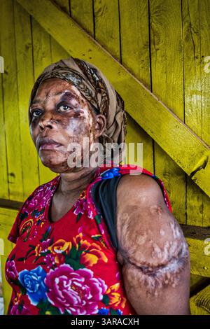 Acid attack survivors in Uganda, Africa Stock Photo - Alamy