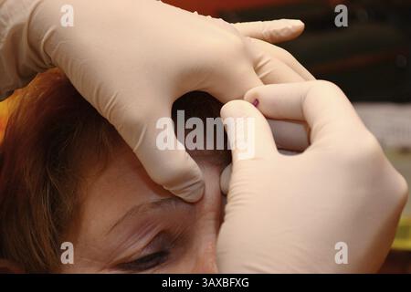 Doctor places acupuncture needle on patient's forehead Stock Photo - Alamy