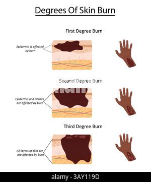 First Degree Burn Stock Vector Image & Art - Alamy