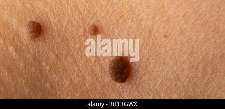 Close-up of multiple seborrheic keratoses, common non-cancerous skin ...