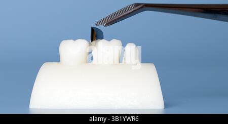 Dental sectional matrix contour system Stock Photo - Alamy