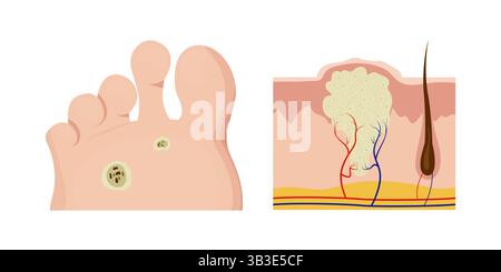vector illustration of warts on the sole Stock Vector Image & Art - Alamy