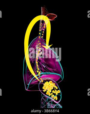 Illustration of aspiration pneumonia, showing how gastric acid and food ...