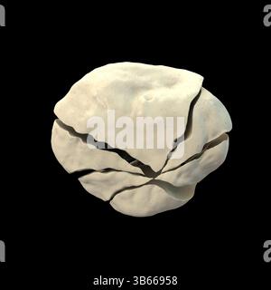 Illustration of a patella multifragmented displaced fracture, showing ...