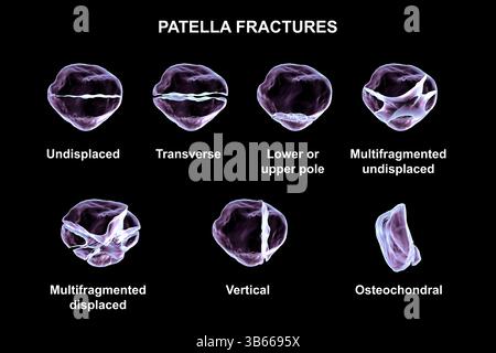 Illustration showing of various patella fractures Stock Photo - Alamy